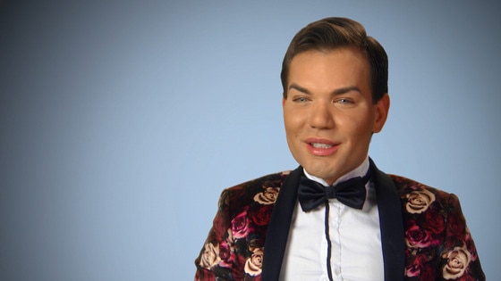 Botched Patient Rodrigo Alves Learns His Nose Could Die and Fall Off ...