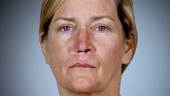 "Botched" Patient Only Has 1 Huge Nostril