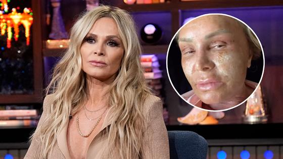 Tamra Judge Shares Her Mom's Reaction to Her Face After Cosmetic Procedure
